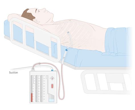 Chest Tube Insertion Ppt