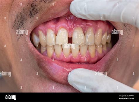 Huge Gap Between The Front Teeth Or Incisors Of Asian Chinese Man