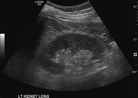 Renal Ultrasound Radiology Key
