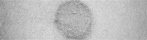 Huidaandoening Ringworm Ringworm Is Eczeem And Psoriasis Facebook