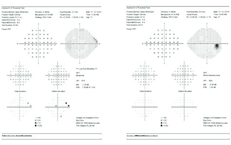 Baseline Humphrey 24 2 Sita Fast Visual Field Plots Show Focally