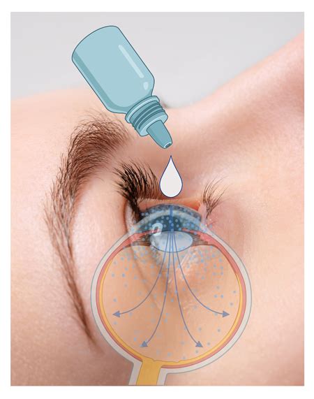 A New Nanoemulsion Eye Drop Formulation Of A Small Molecule Runx1 Inhibitor Statnano