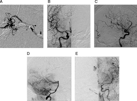 Transarterial Balloon Assisted Onyx Embolization Of Pericallosal Arteriovenous Malformations