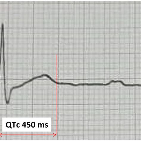 The ECG Showing Normalized Length Of The QT Interval Download Scientific Diagram