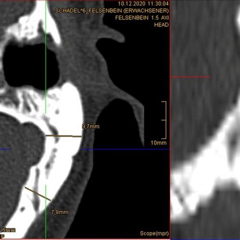 Cochlear™ Osia® System Implants Osi100 And Osi200 With Audio Processor Download Scientific