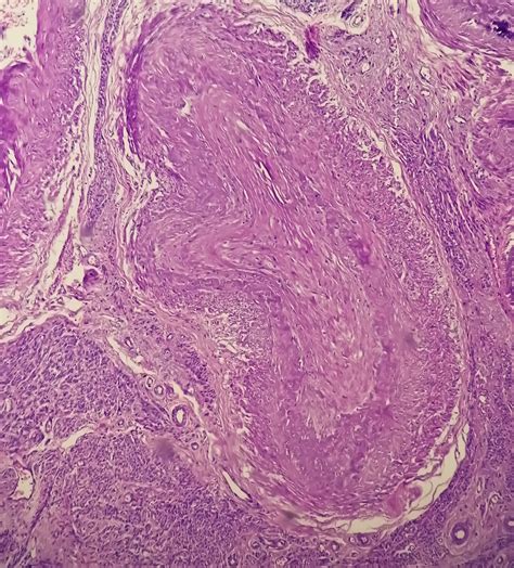 Pelvic Organ Prolapse