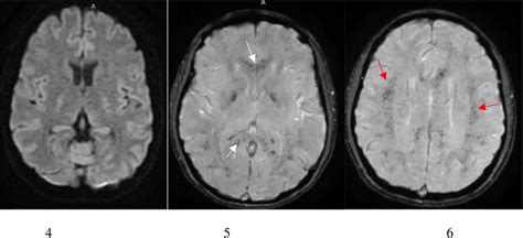 4 Axial Dwi Sequence Appears Normal No Areas Of Restriction Were
