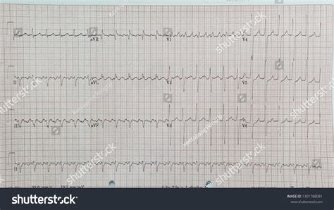 Atypical Atrial Flutter Rapid Ventricular Response Stock Photo Shutterstock