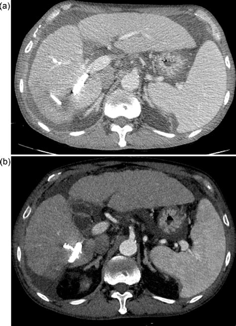 Follow Up Computed Tomography Ct After Percutaneous Transhepatic Download Scientific Diagram