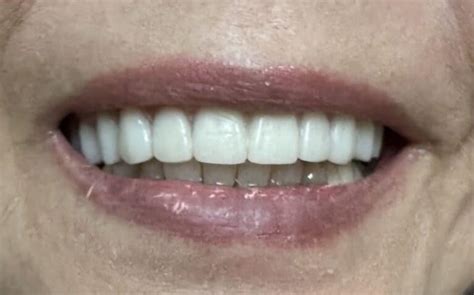 Upper Full Arch Fixed Screw Retained Hybrid Implant Prosthesis Case
