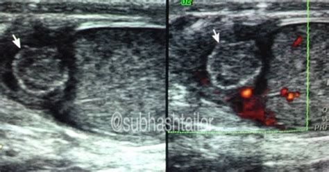 Sono Digest Torsion Of Testicular Appendix A Sonographic Depiction