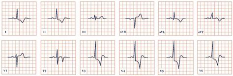 Jpm Free Full Text Broad Electrocardiogram Syndromes Spectrum From Common Emergencies To