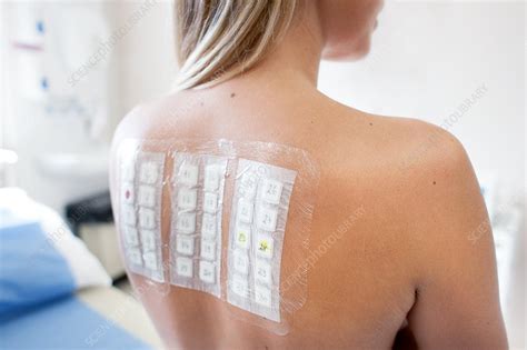 Patient Undergoing A Patch Test In Allergy Clinic Stock Image F