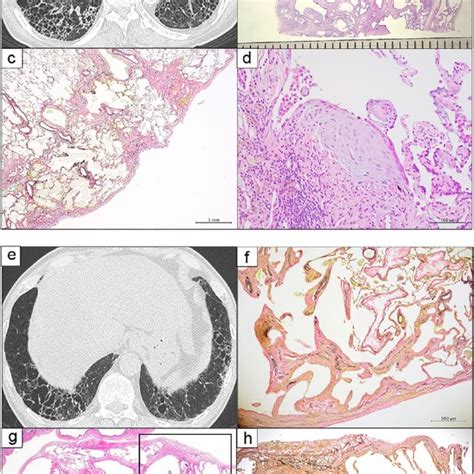 Comparison Of Hrct Scan Findings And Histopathological Patterns Between Download Scientific