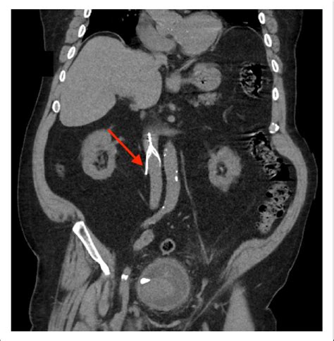 Ct Abdomen And Pelvis Coronal View Demonstrating One Of The Ivc Filter Download Scientific