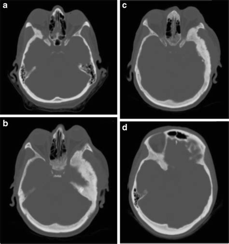 Different Patterns Of Bone Involvement In Sphenoorbital Meningiomas As