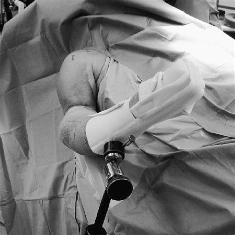 4 A Blunt Tipped Elevator Or Small Bone Tamp Is Placed Through The