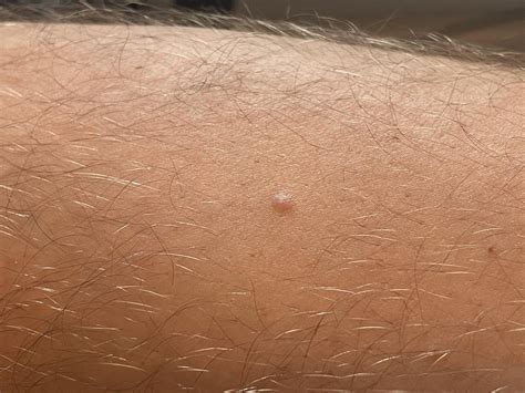 33m With Hard Bump On Shin Probably Developed In The Last Few Months