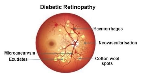 Sensors Free Full Text Deep Learning Approach For Automatic Microaneurysms Detection