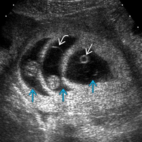 Triplets And Beyond Radiology Key