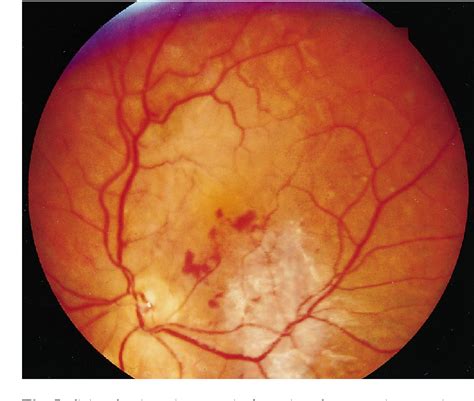 Choroidal Sclerosis Semantic Scholar