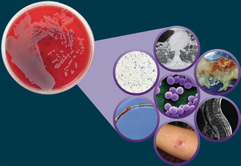 Staphylococcus Epidermidis Infections