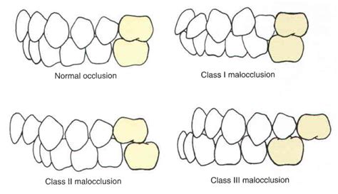 Angles Classification For Malocclusions Dentalnotebook