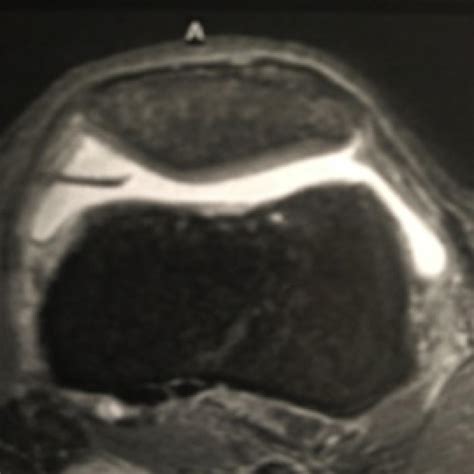 The Plica Syndrome Praxisklinik Werneck