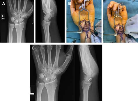 Scaphoid Lunate Fracture