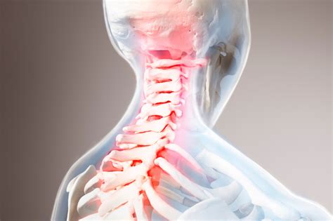 50 Facts About Spasmodic Torticollis