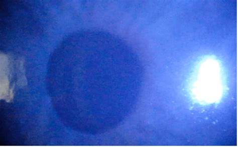 how the istent inject can improve outcomes in patients with osd and