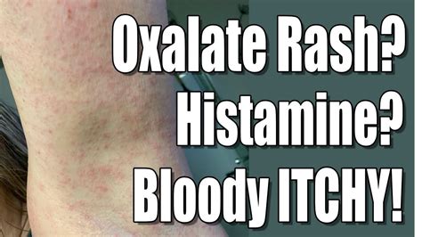 Oxalate Dumping Skin Rash Histamine Connections Between Oxalate