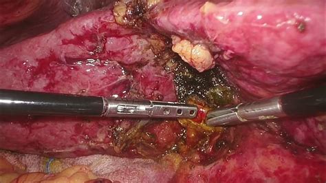 Laparoscopic Subtotal Cholecystectomy When And How Youtube