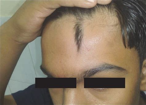 Nevoid Hypertrichosis Case Report With Review Of The Literature Pmc