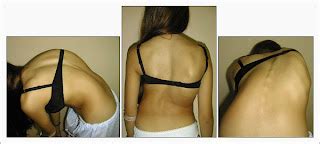 Guest Post Sex And Scoliosis FWD Forward
