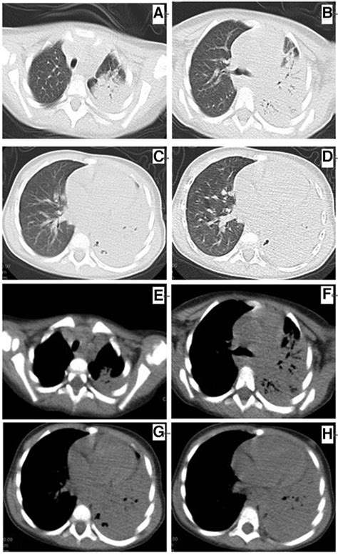 Frontiers An Unusual Presentation Of Necrotizing Pneumonia Caused By