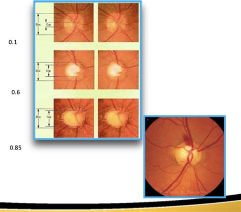 Glaucoma Flashcards Quizlet