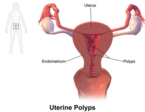 Cervical And Uterus Polyps Womens Magazine Advice For Health