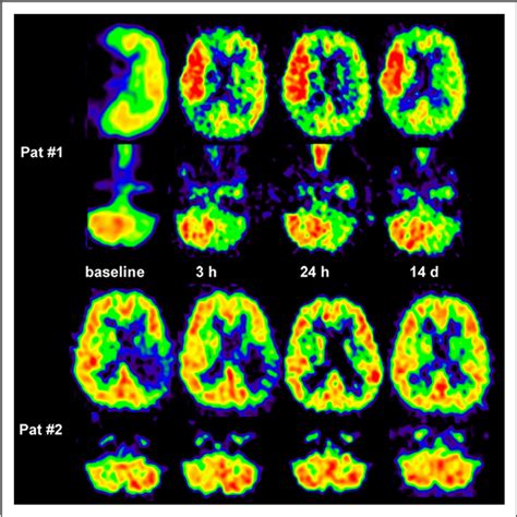 Figure 5 From Radionuclide Imaging In Ischemic Stroke Semantic Scholar