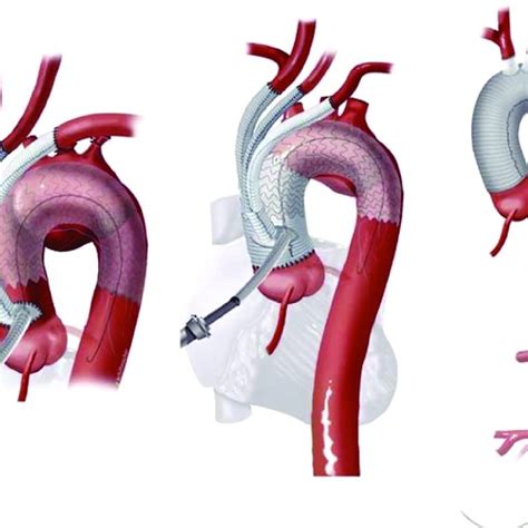Zone 2 Arch Repair Zone 2 Aortic Arch Repair With Debranching Of The Download Scientific