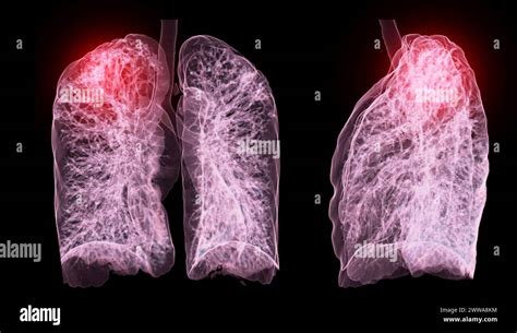 A Ct Chest 3d Scan Displaying A Lesion At The Right Upper Lobe Offers A Detailed Visualization
