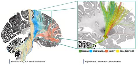 new deep brain stimulation algorithm may help personalize parkinson s
