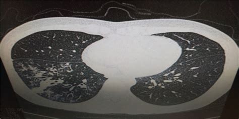 Rapid Resolution Of Reversible Bronchiectasis After Mycoplas Medicine