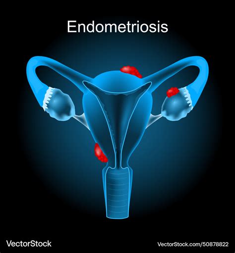 Endometriosis Cross Section Of A Human Uterus Vector Image