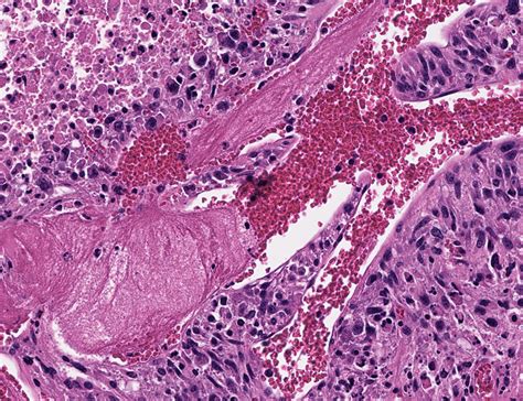 Cd4 T Cells With Convergent Tcr Recombination Reprogram Stroma And