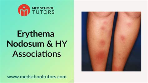 Erythema Nodosum Geeky Medics