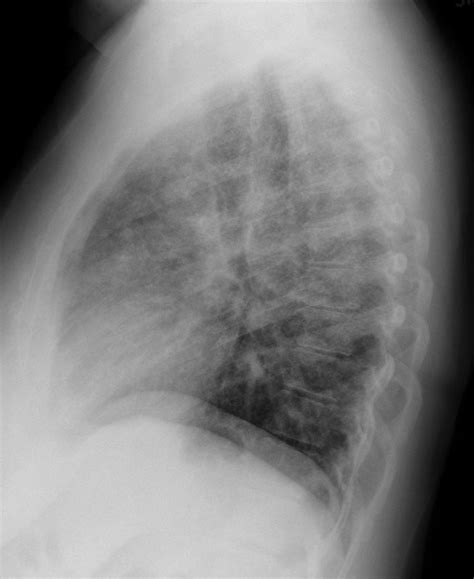 Cxr Reticulonodular Pattern The Common Vein