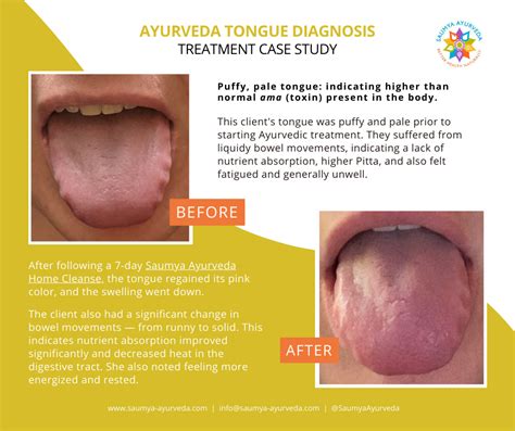 Ayurveda Tongue Diagnosis What Your Tongue Is Saying About Your Health
