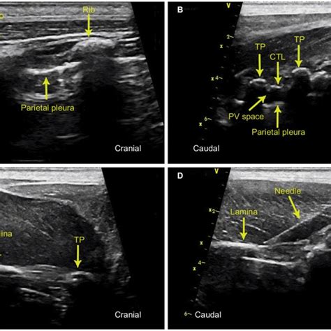 Pdf The Ultrasound Guided Retrolaminar Block Volume Dependent Injectate Distribution