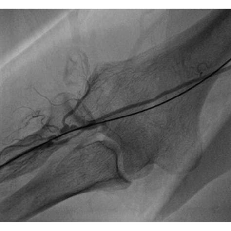 A Radial Angiogram Demonstrating Occlusive Radial Spasm B Radial